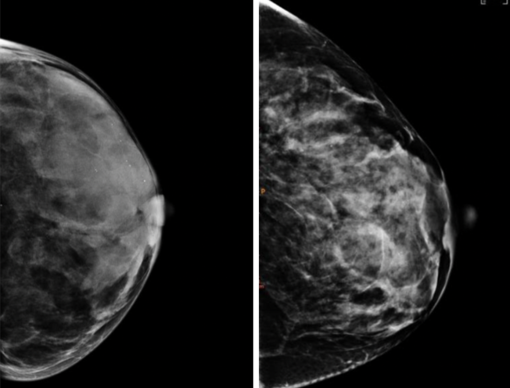 Breast Textures Seen on Mammograms Linked to Cancer Risk | Columbia ...