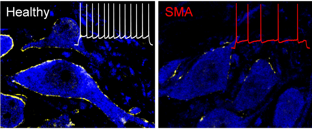 Spinal Muscular Atrophy: New Clues to Cause and Treatment | Columbia ...