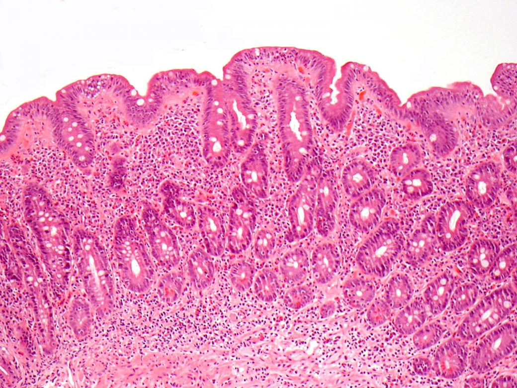 Celiac Disease Patients with Ongoing Intestine Damage at Lymphoma Risk ...