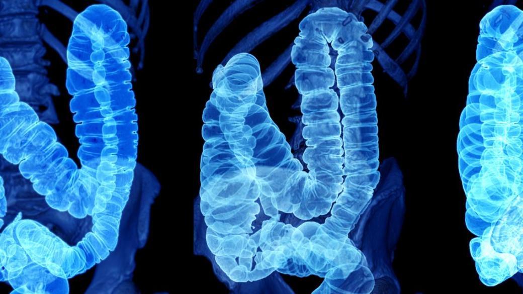 News | Columbia University Irving Medical Center