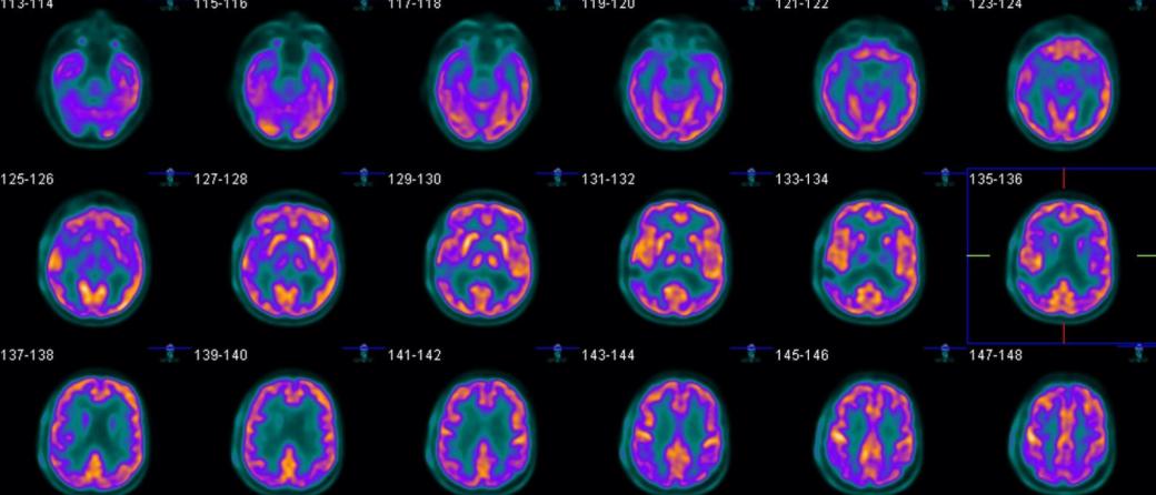 New Insights into Melanoma Brain Metastases | Columbia University ...