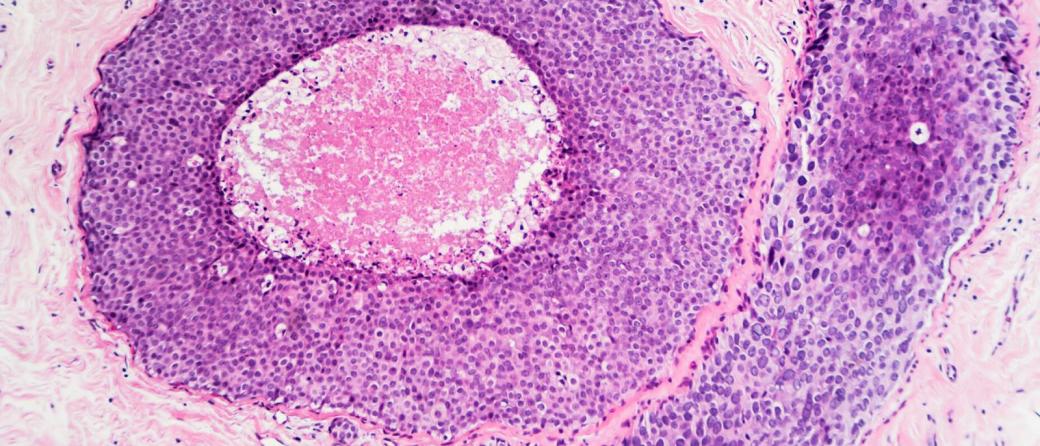 “Stage Zero” Breast Cancer: What’s the Optimal Treatment for DCIS ...