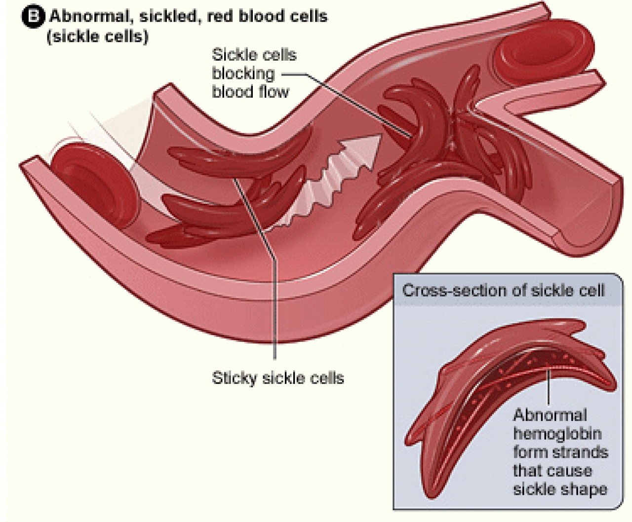 Genes May Predict Response to Sole Sickle Cell Drug | Columbia ...