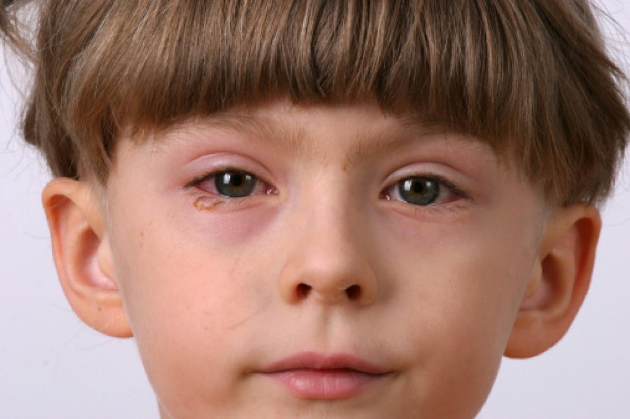 How to Tell If Your Child Has Pink Eye | Columbia University Irving ...