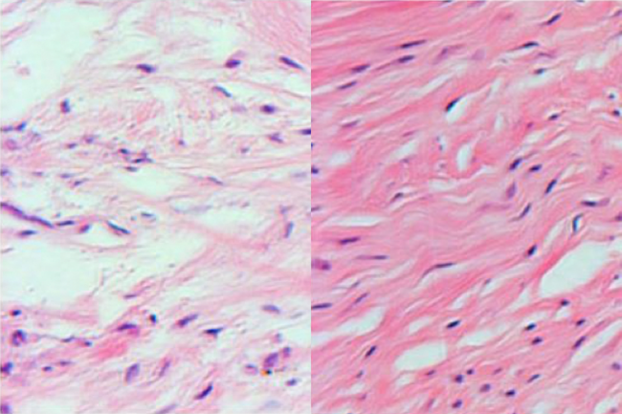 Meniscus Regenerated with 3-D Printed Implant | Columbia University ...