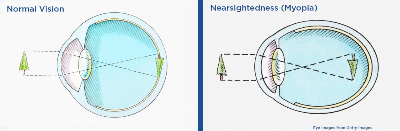 Shaping the Eye for Perfect Vision | Columbia University Irving Medical ...