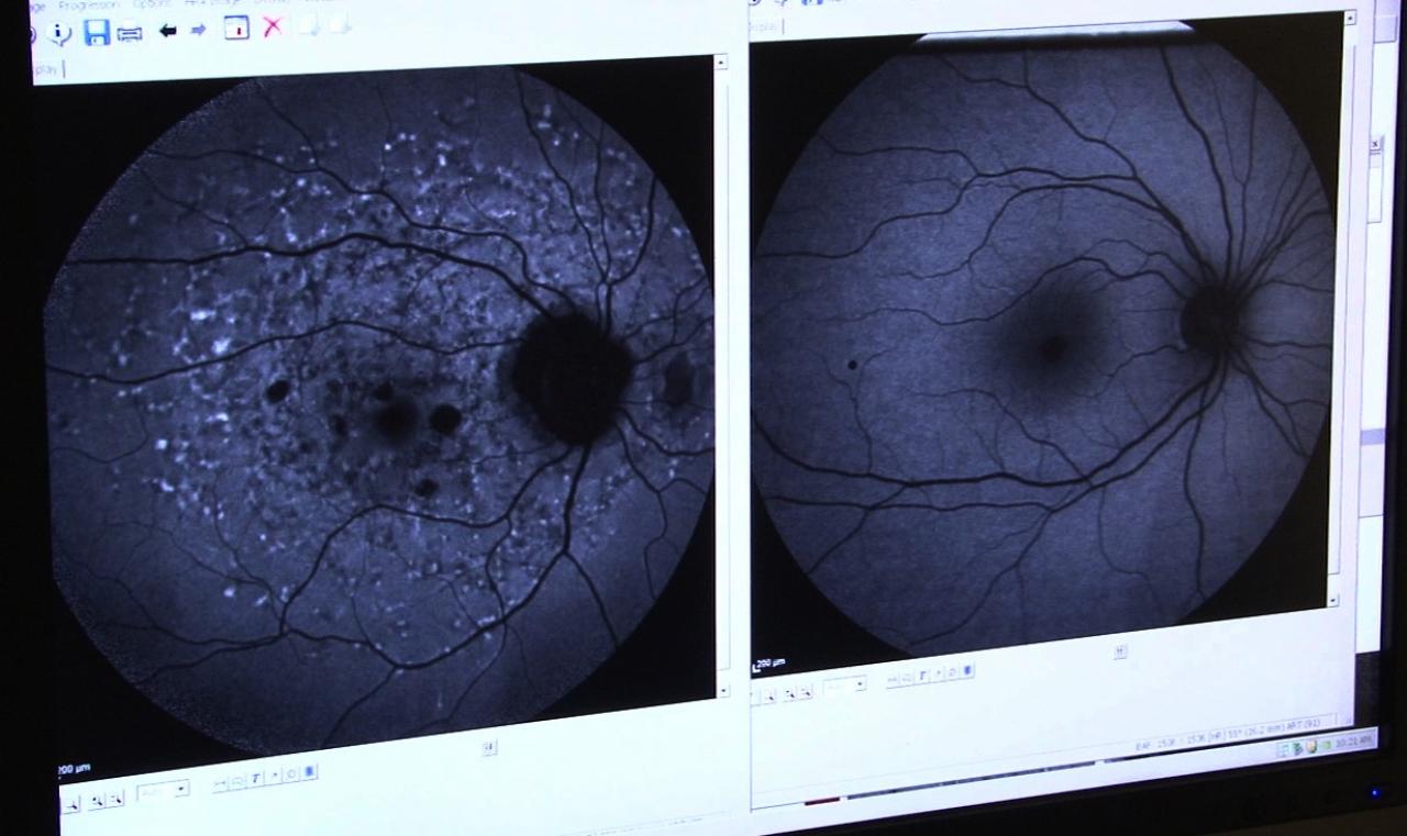 With Cells from Patients, Researchers Recreate Eye Disease in a Dish ...