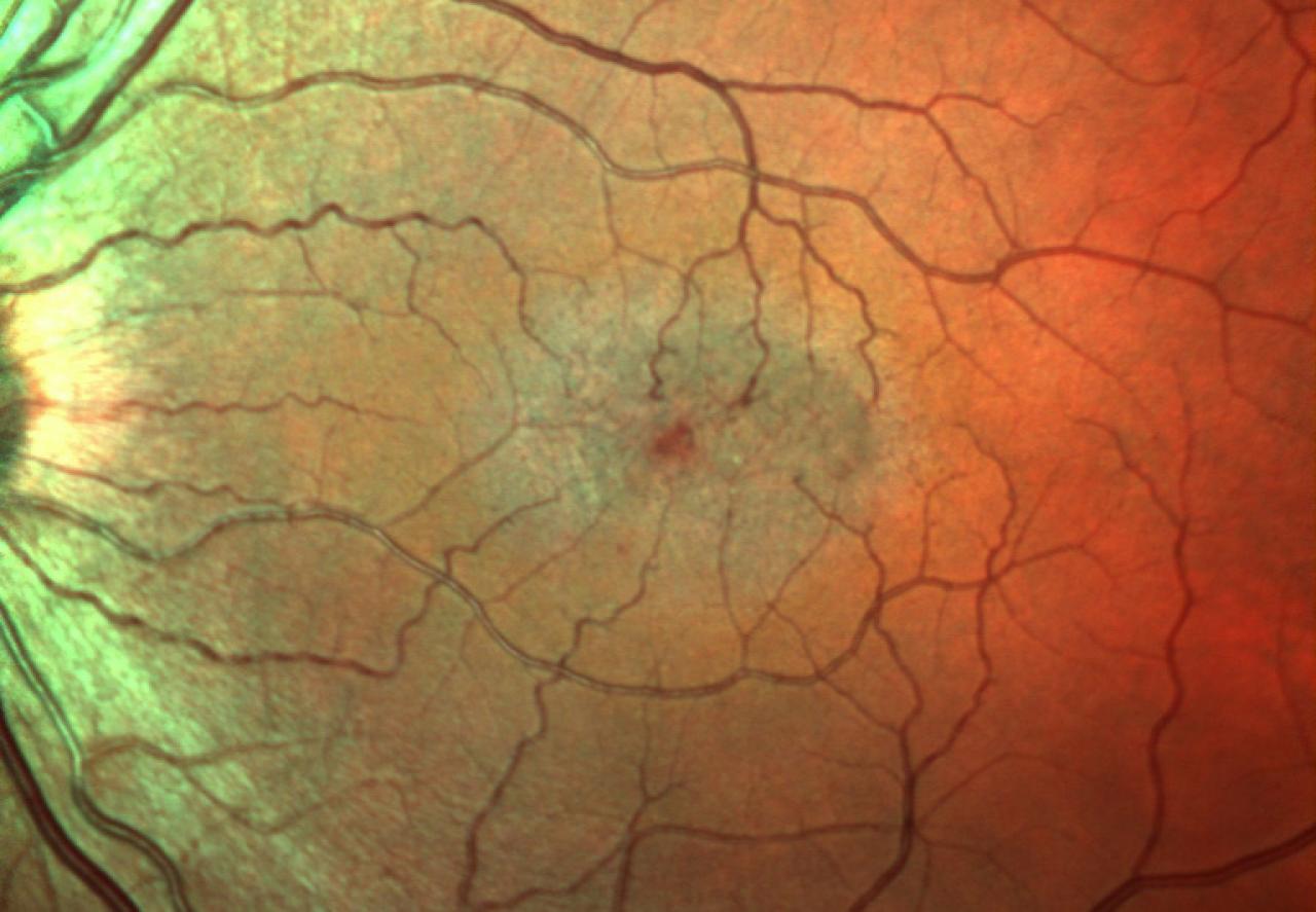New Study Uncovers First Genetic Clues to Rare Eye Disease | Columbia ...