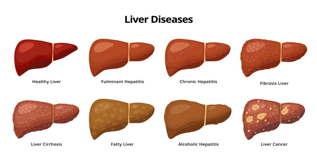 Liver Disease and Why It’s a Concern for Asian Americans and Pacific ...