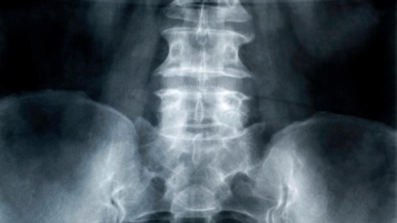 Study Finds Belly Fat is Associated with Poor Bone Quality | Columbia ...