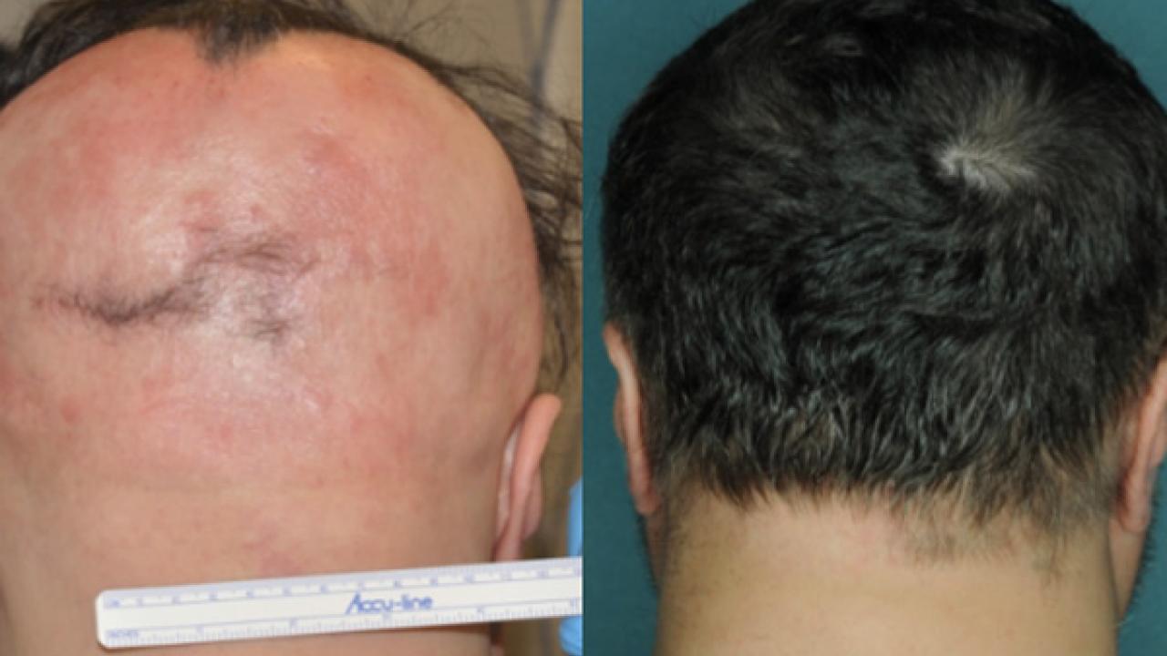 Drug Restores Hair Growth in Patients with Alopecia Areata | Columbia ...