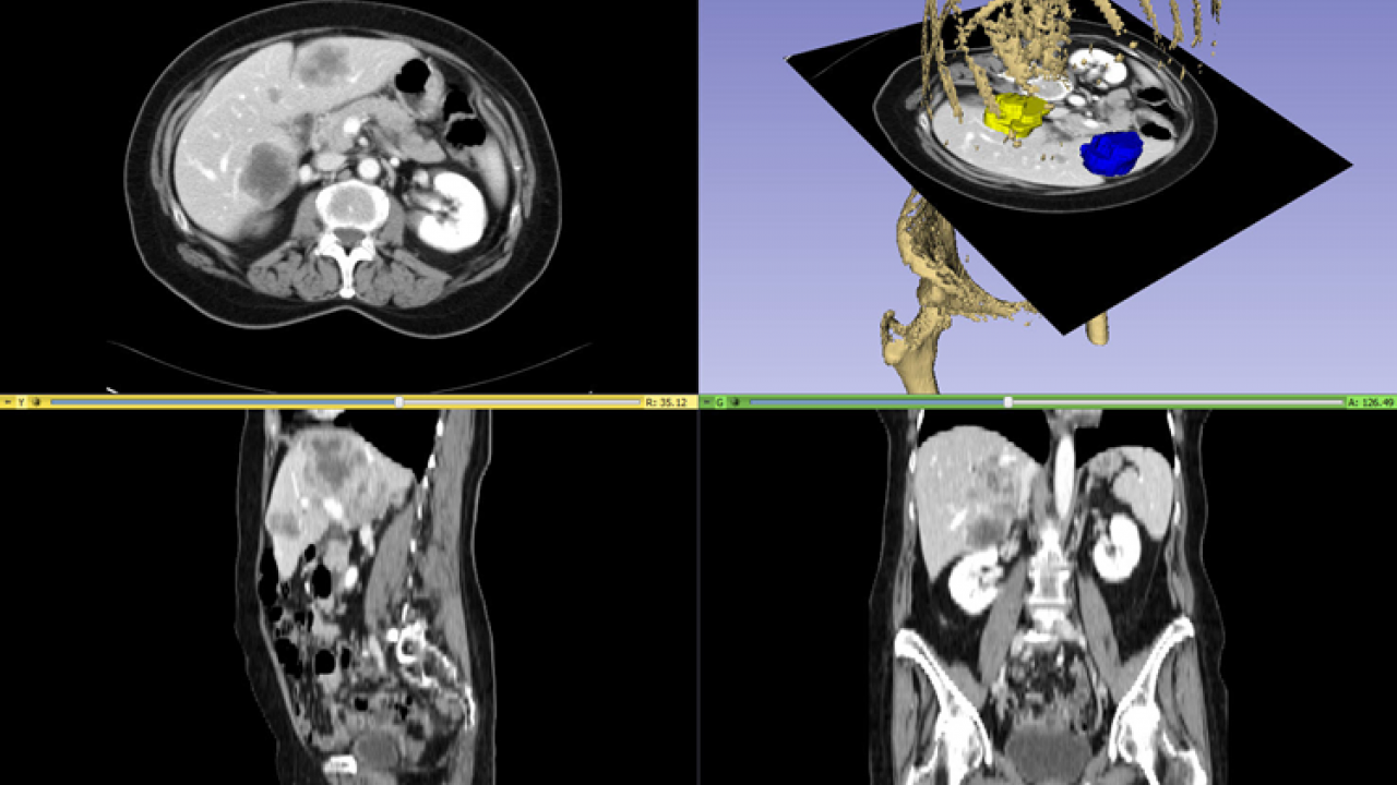 Cancer Imaging: Radiologists Developing Better Ways to Track Tumors ...