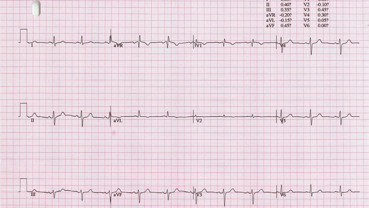 Aspirin and Warfarin Effective for Most Heart Failure Patients ...