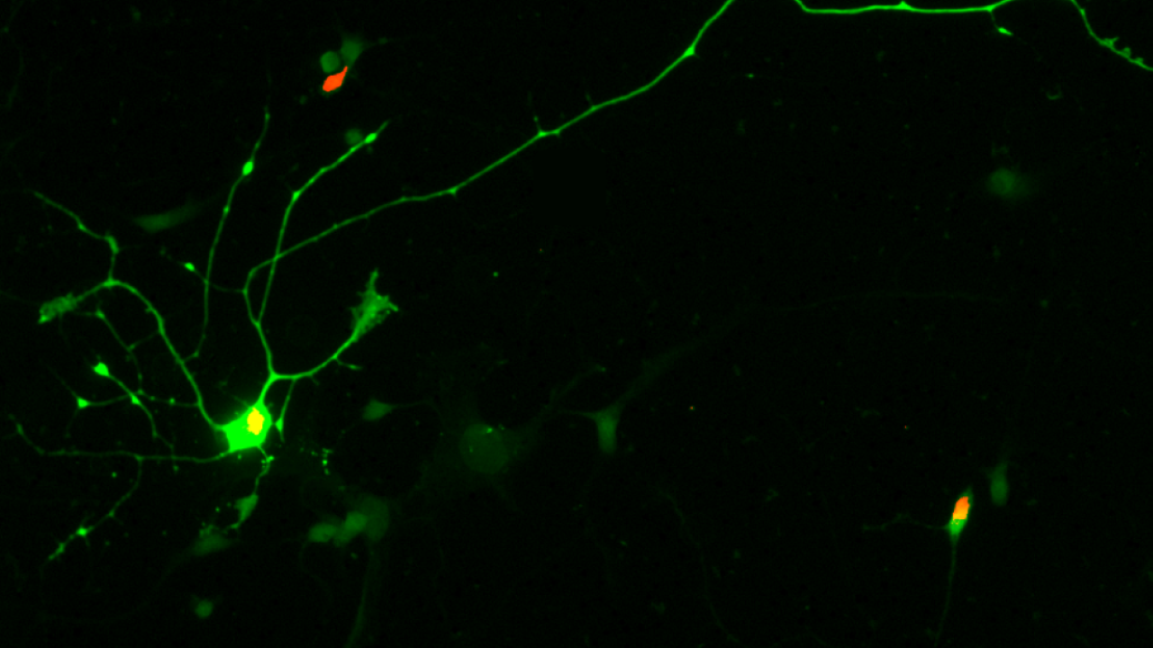 Potential ALS Treatment Emerges from Nerve Cells in a Dish | Columbia ...