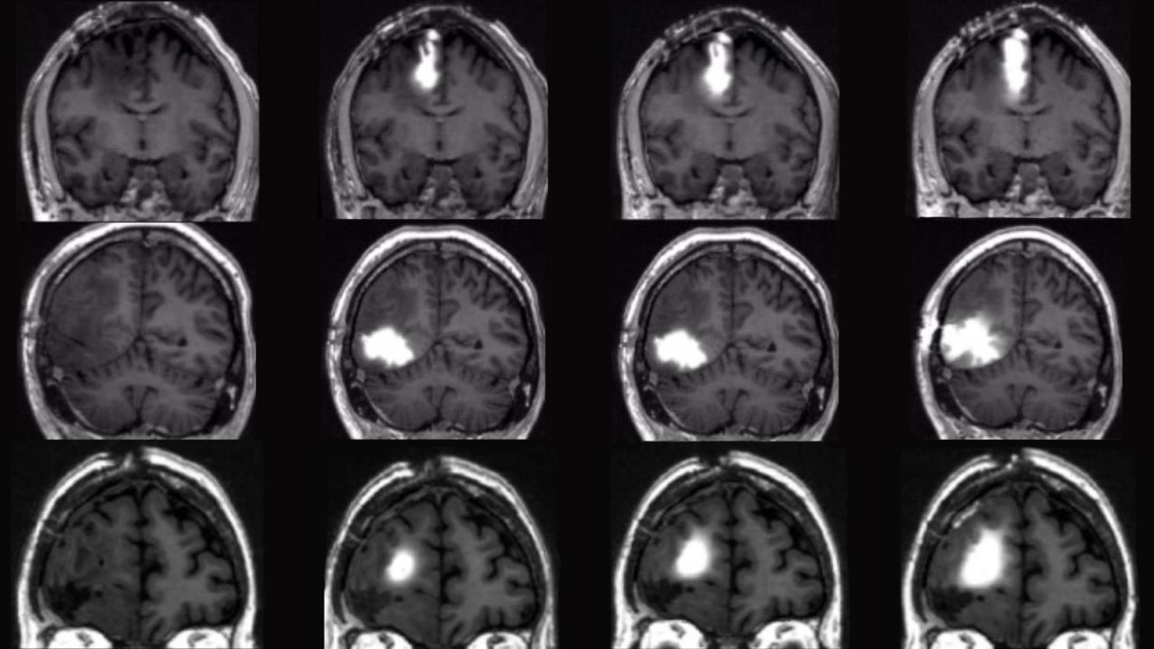 Brain Cancer Mri