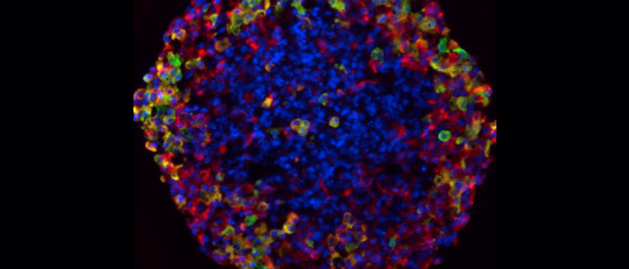 CRISPR, Stem Cells, and Neonatal Diabetes | Columbia University Irving ...