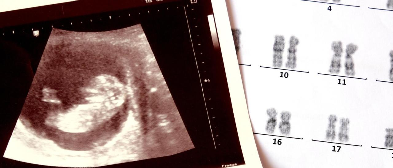 New Prenatal Test Can Reduce Time, Cost of Detecting Chromosomal ...