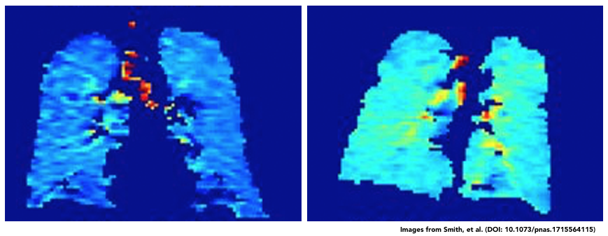 One in Four Have Unusual Lungs—And That May Raise Lung Disease Risk ...