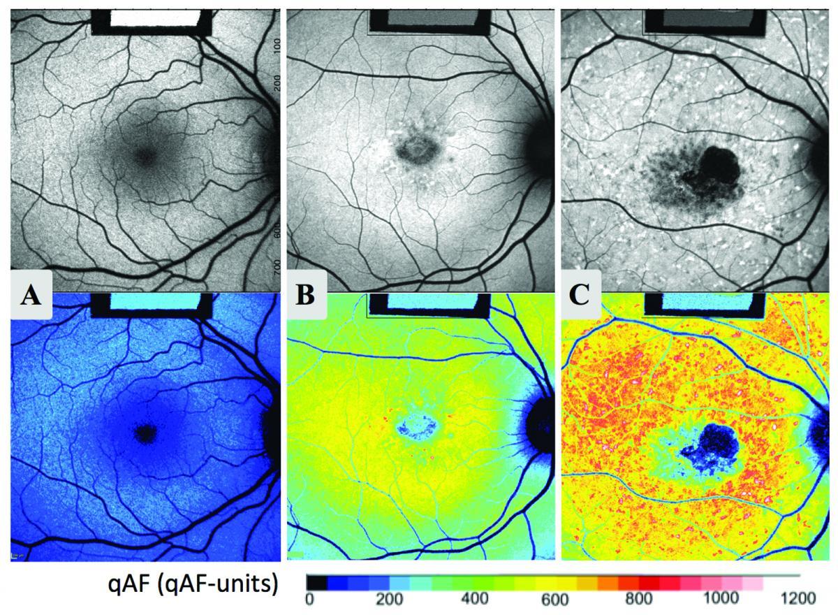 Using The Retina s Natural Fluorescent Light To Measure And Treat Using The Retina s Natural Fluorescent Light To Measure And Treat