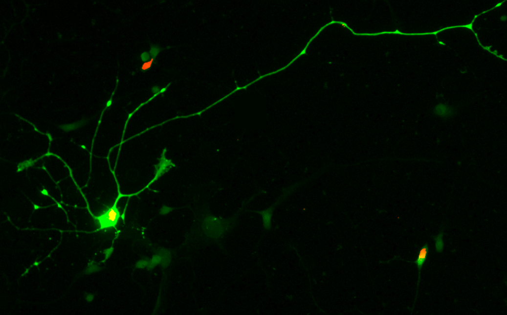 Potential ALS Treatment Emerges from Nerve Cells in a Dish | Columbia ...