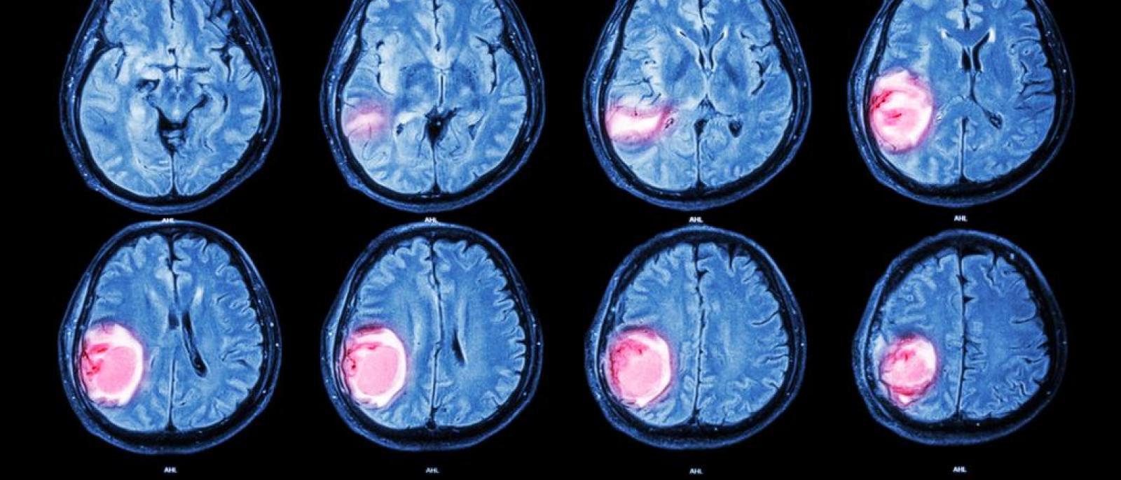 One in Five Brain Cancers Fueled by Overactive Mitochondria | Columbia ...