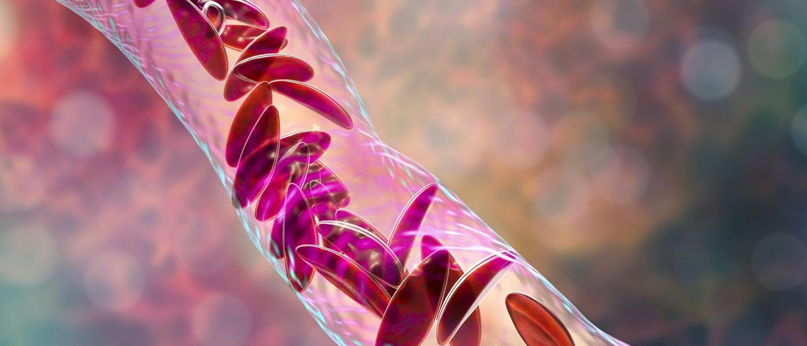 Experimental Gene Therapy Reverses Sickle Cell Disease for Years ...