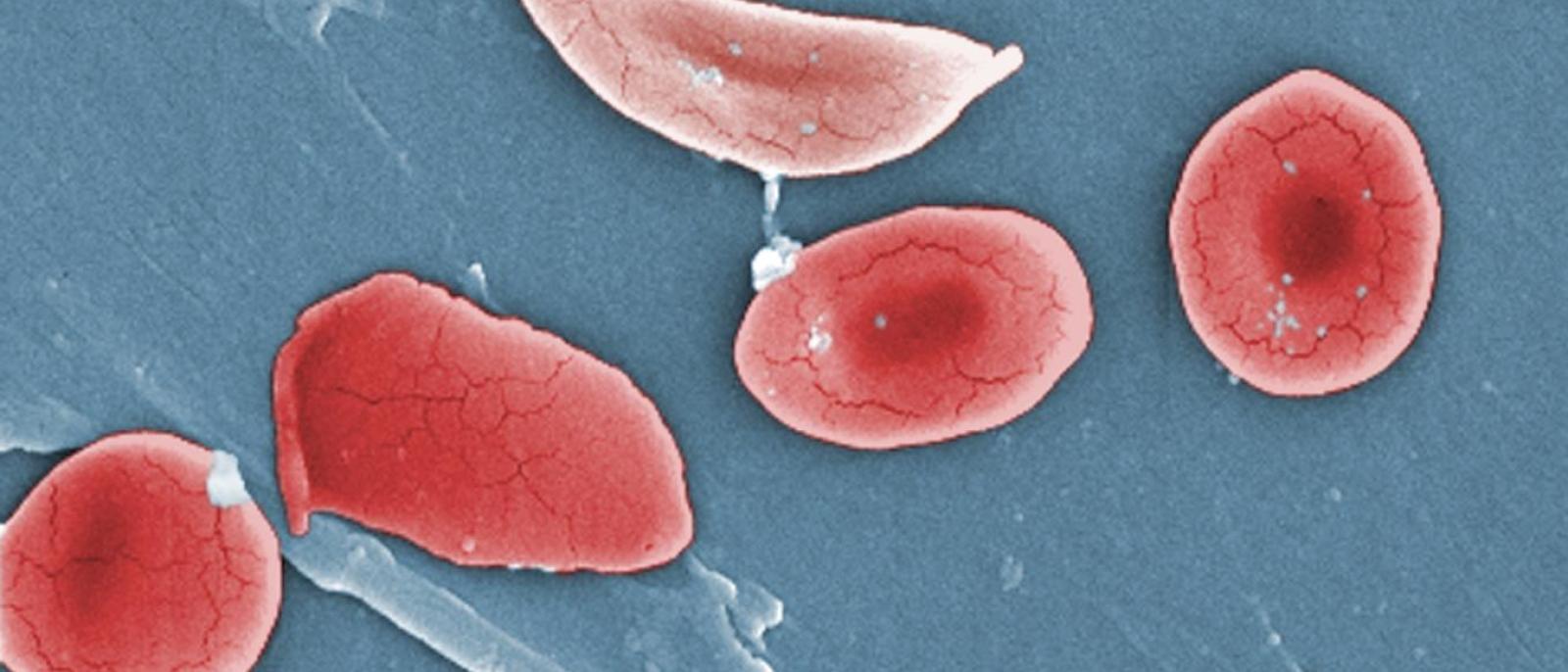 First CRISPR Therapy Approved for Sickle Cell | Columbia University ...