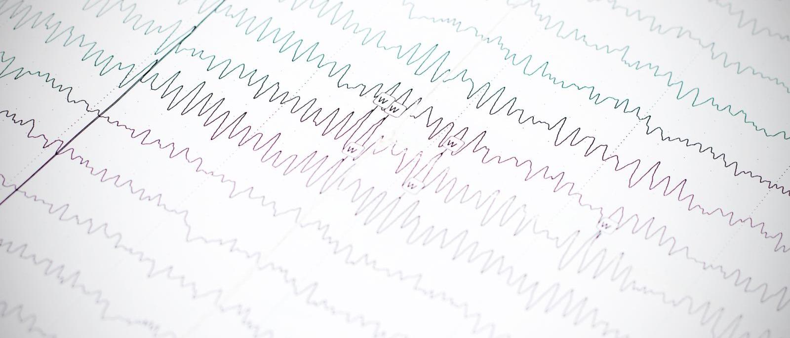 Sleep Patterns May Reveal Comatose Patients with Hidden Consciousness ...