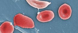 First CRISPR Therapy Approved for Sickle Cell | Columbia University ...