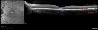 Eye Damage from Powerful Lasers Alarms Ophthalmologists | Columbia ...