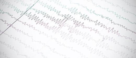 Sleep Patterns May Reveal Comatose Patients with Hidden Consciousness ... Sleep Patterns May Reveal Comatose Patients with Hidden Consciousness ...