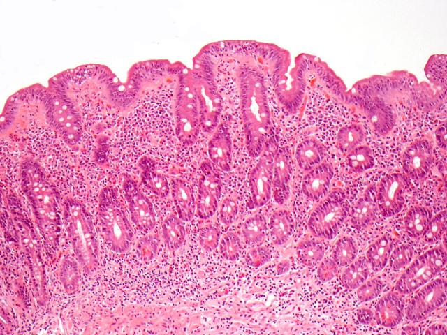 Celiac Disease Patients with Ongoing Intestine Damage at Lymphoma Risk ...