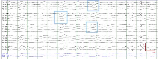 Sleep Patterns May Reveal Comatose Patients with Hidden Consciousness ... Sleep Patterns May Reveal Comatose Patients with Hidden Consciousness ...