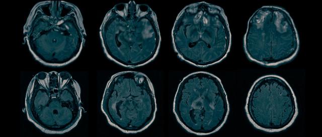 Source of Hidden Consciousness in ‘Comatose’ Brain Injury Patients ...