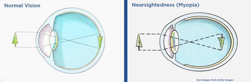 Shaping the Eye for Perfect Vision | Columbia University Irving Medical ...
