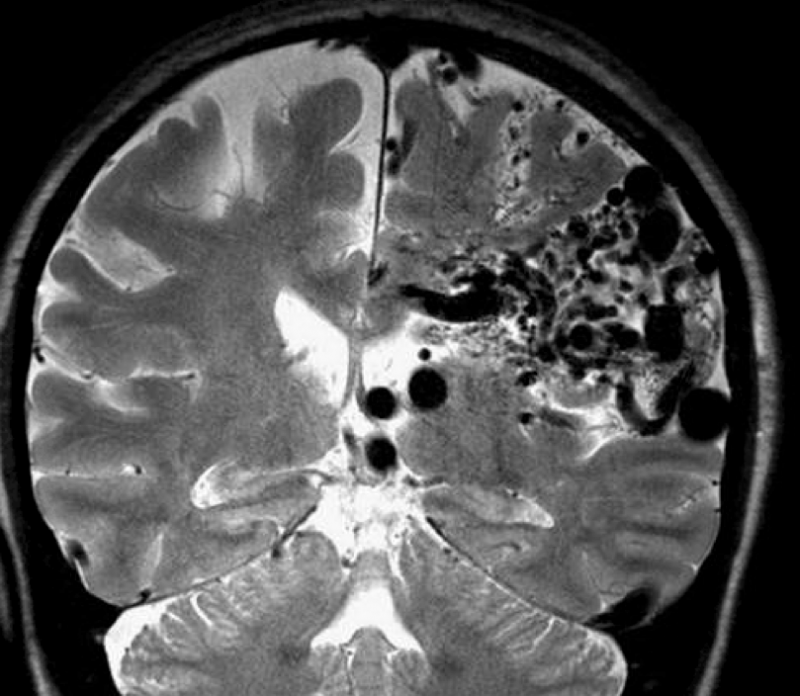 Best Treatment for Unruptured Brain AVMs at Present May Be Medical ...