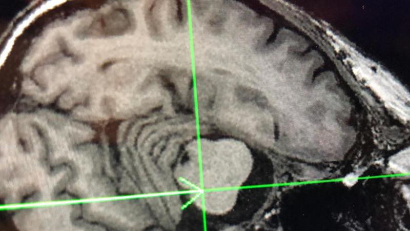 Brain Cancer | Columbia University Irving Medical Center