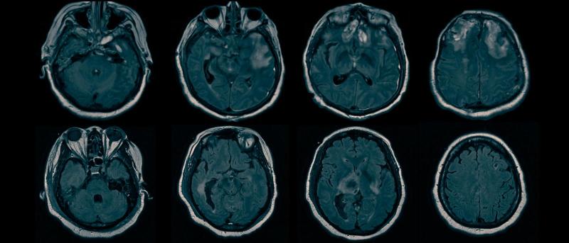 Source of Hidden Consciousness in ‘Comatose’ Brain Injury Patients ...